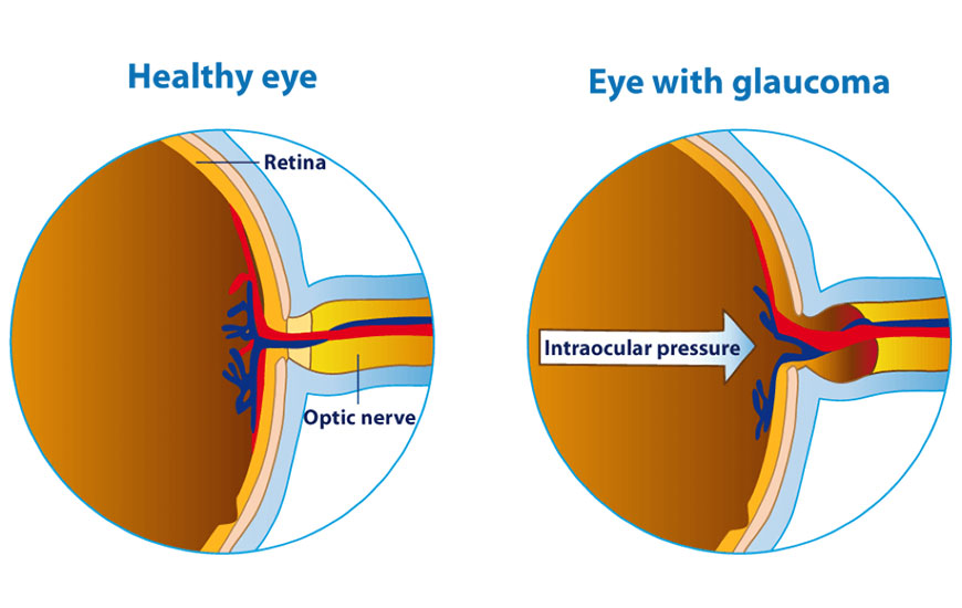 Glaucoma An Insight Zo Mo Opticals